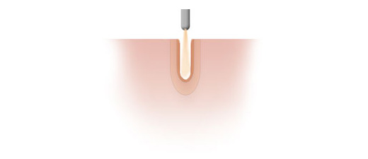 Advanced CO2 Laser Systems and Fibers » OmniGuide Surgical
