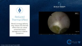 Revolix HTL BPH Enucleation » OmniGuide